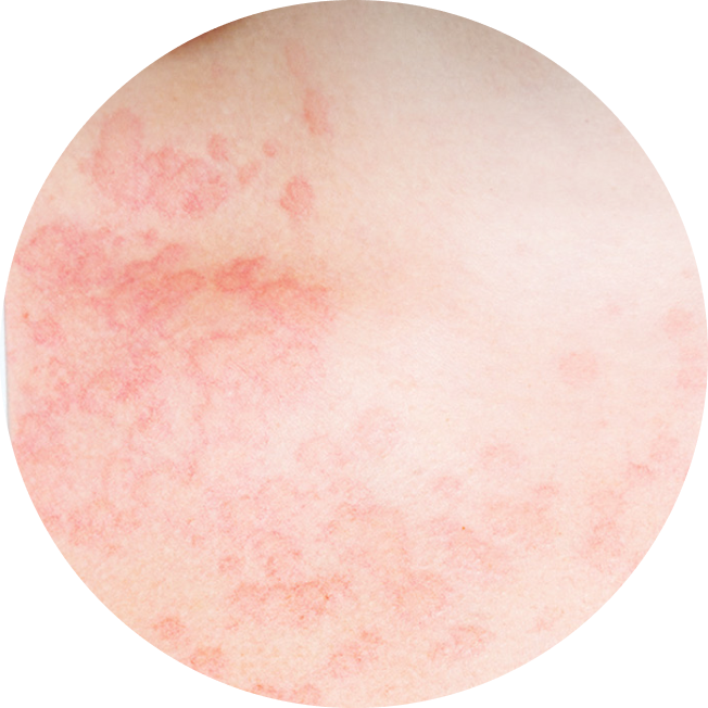 What Are Chronic Hives? | Xolair® (omalizumab)