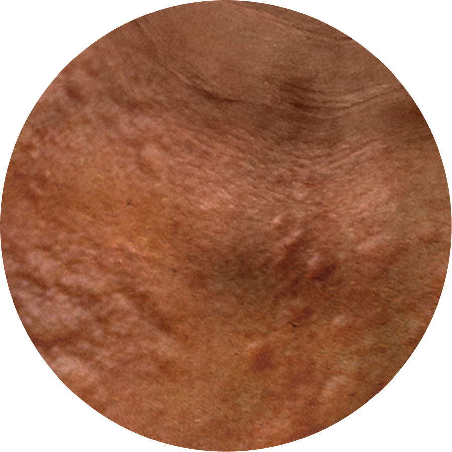 What Are Chronic Hives? | Xolair® (omalizumab)