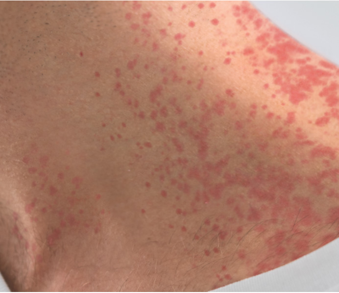 XOLAIR® (omalizumab) Clinical Results For Chronic Hives & Itching