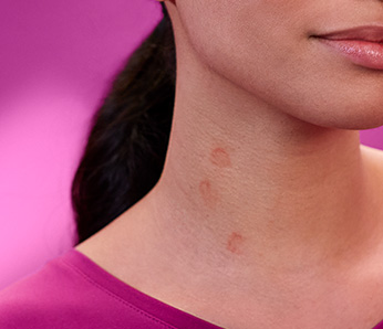 XOLAIR® (omalizumab) Clinical Results For Chronic Hives & Itching