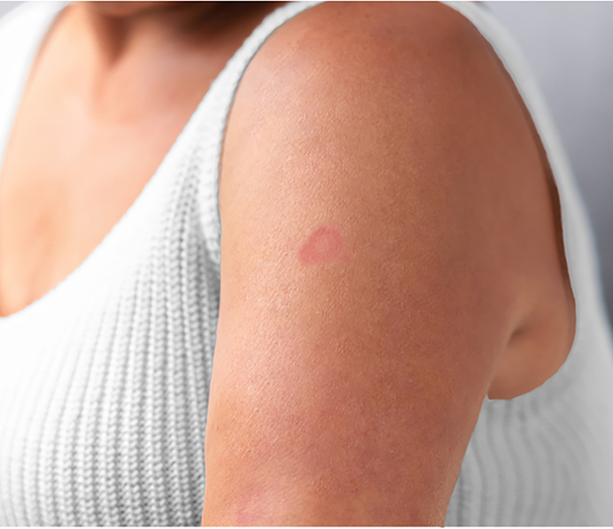 XOLAIR® (omalizumab) Clinical Results For Chronic Hives & Itching