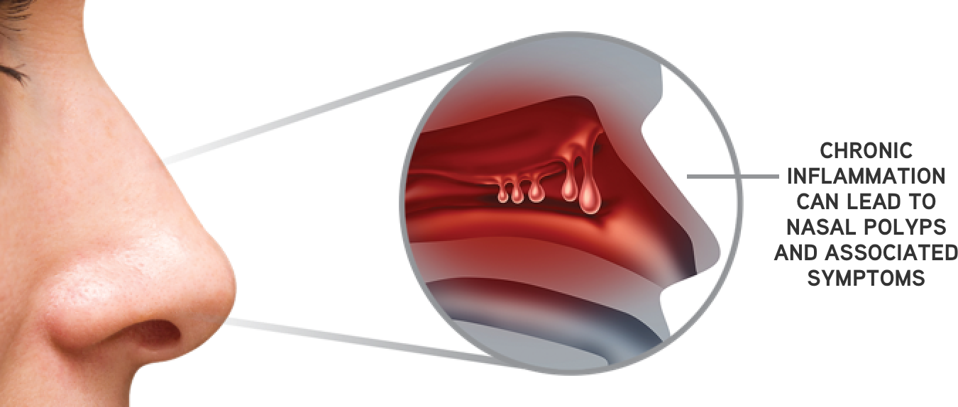 What is Chronic Rhinosinusitis with Nasal Polyps (CRSwNP)? | XOLAIR ...